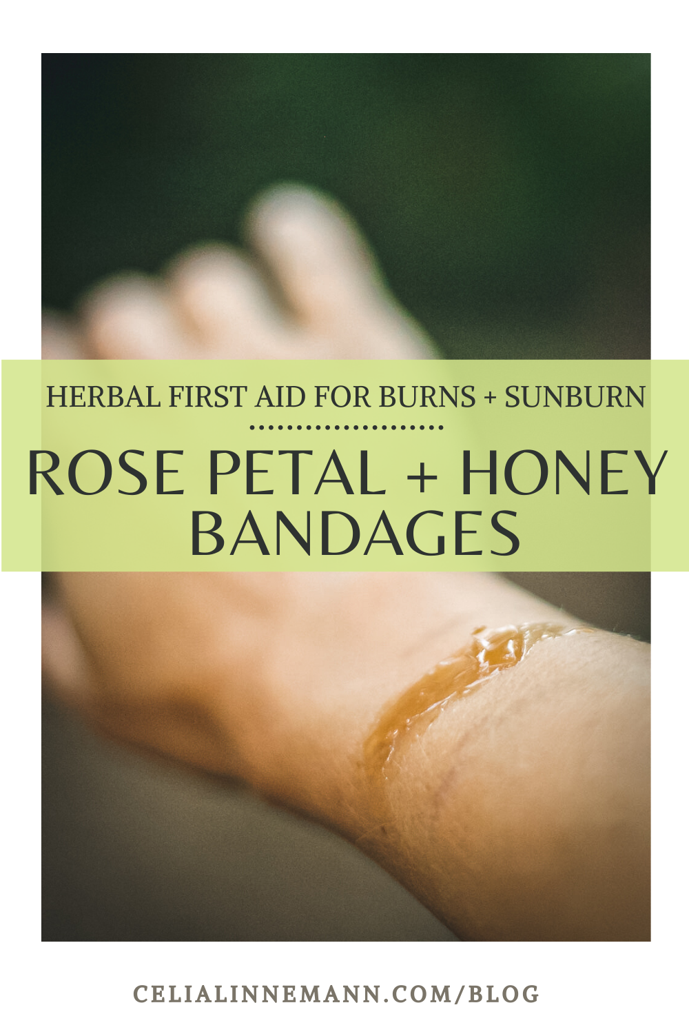 Herbal First Aid: Rose Petal Bandages, My Favorite Burn and Sunburn ...